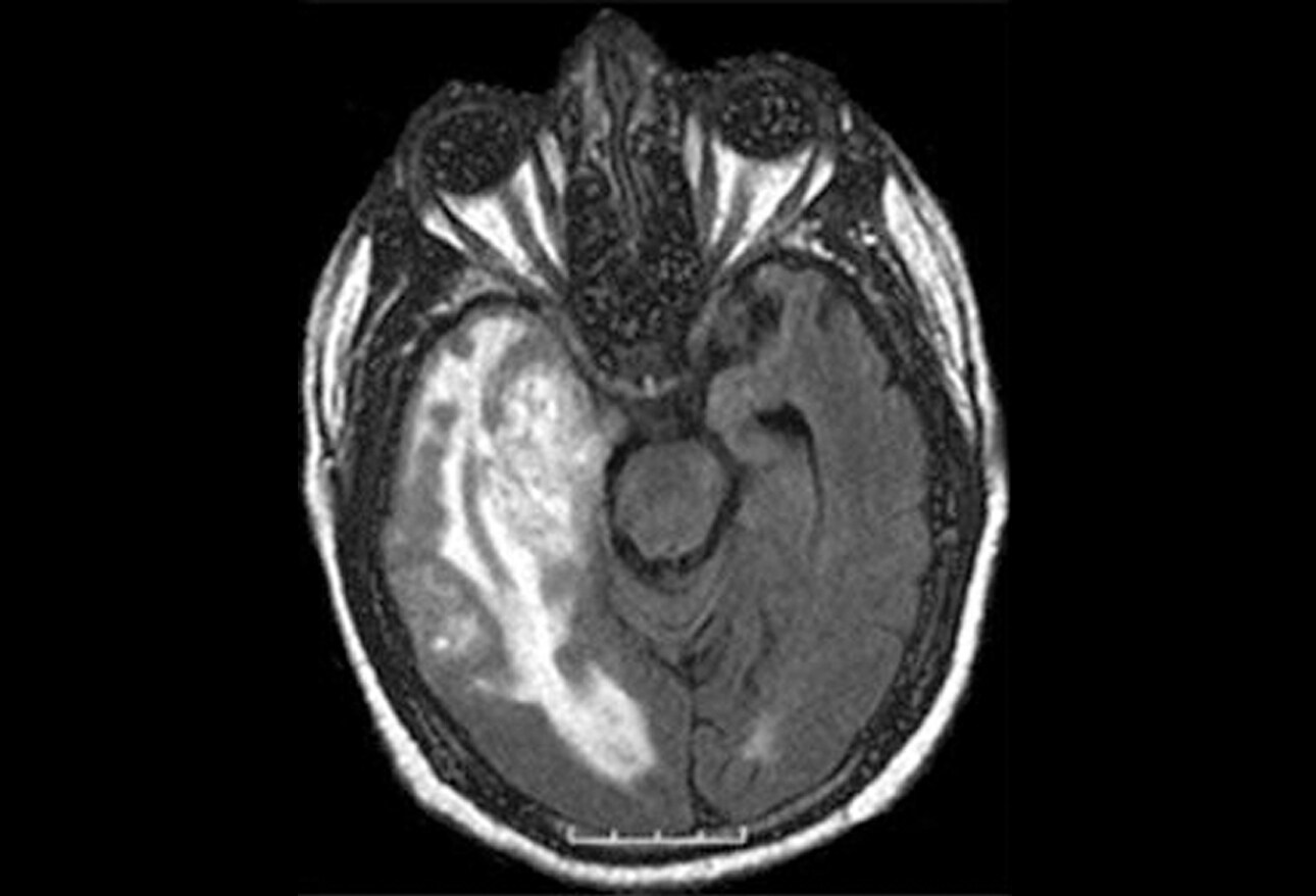 Adult Brain Tumors: A Spreading Problem