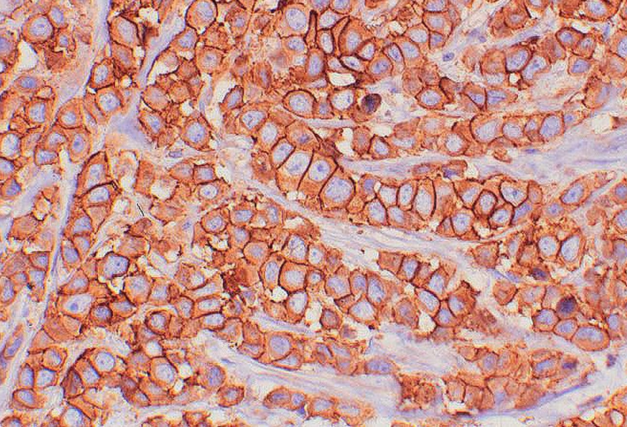 Advanced Breast Cancer: The Later Stages