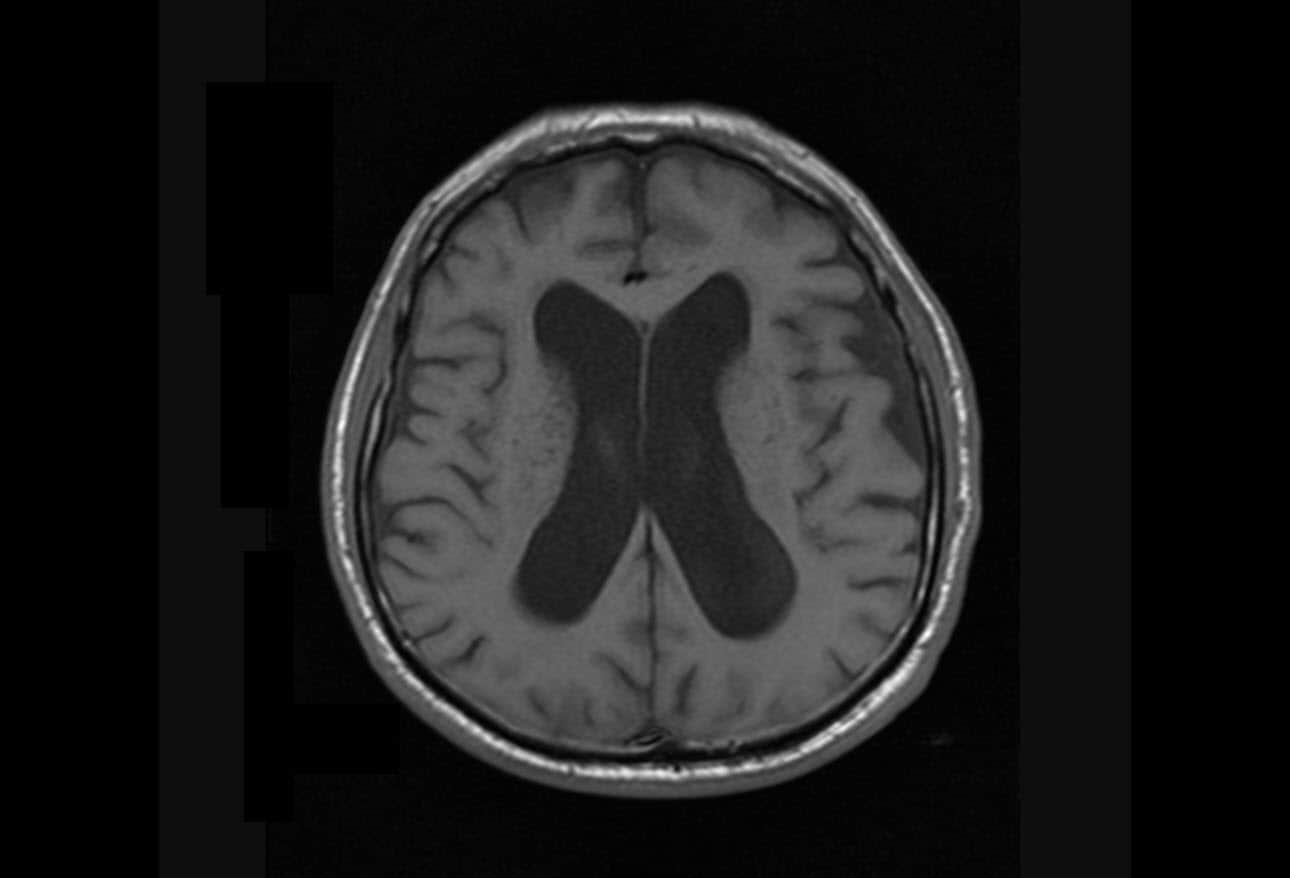8 Causes Of Altered Mental Status In The Elderly