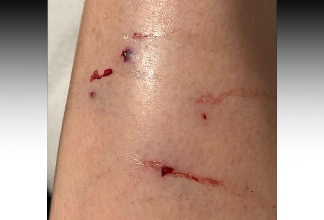 Animal Bites: What You Need to Know