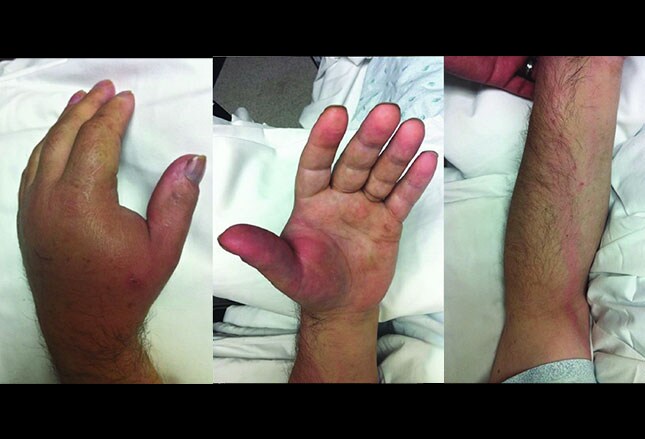 Animal Bites: What You Need to Know