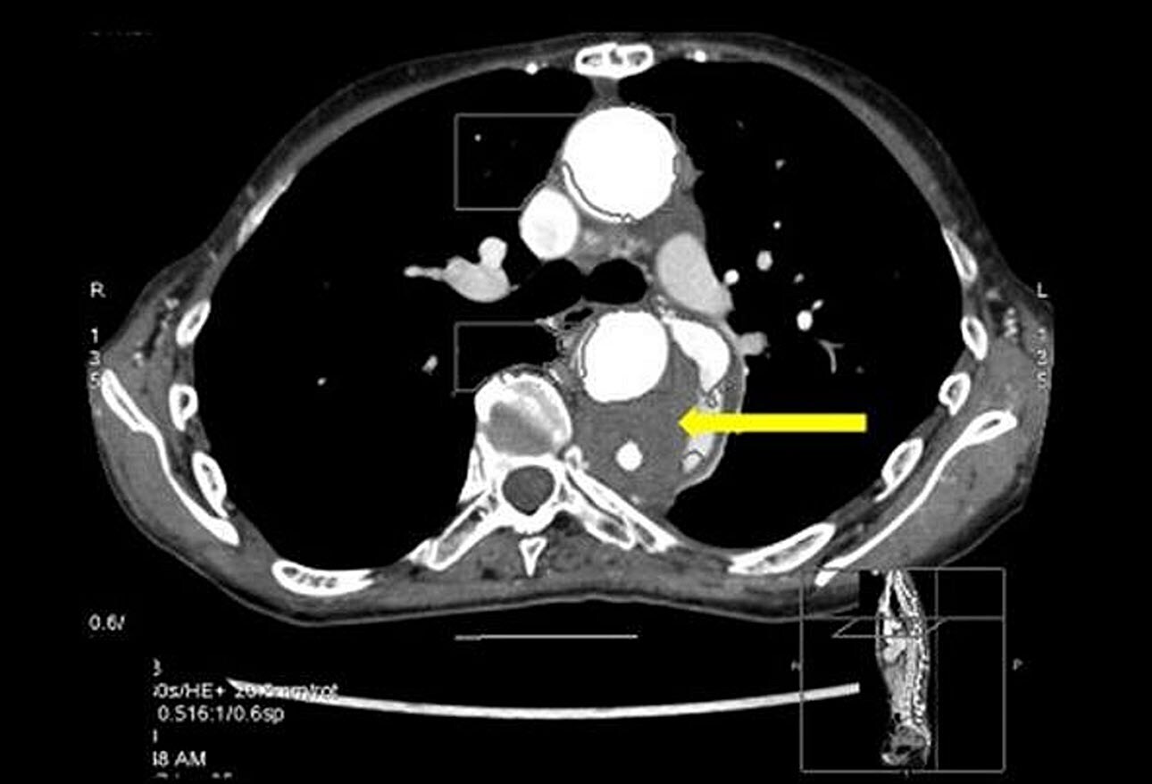 Aortic Dissection: A Double-Barreled Threat