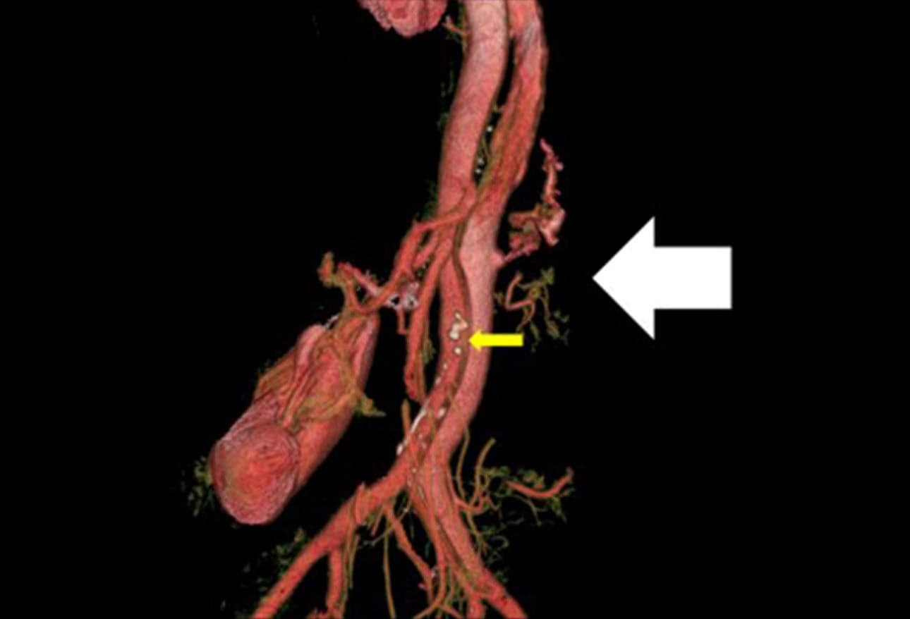 Aortic Dissection: A Double-Barreled Threat