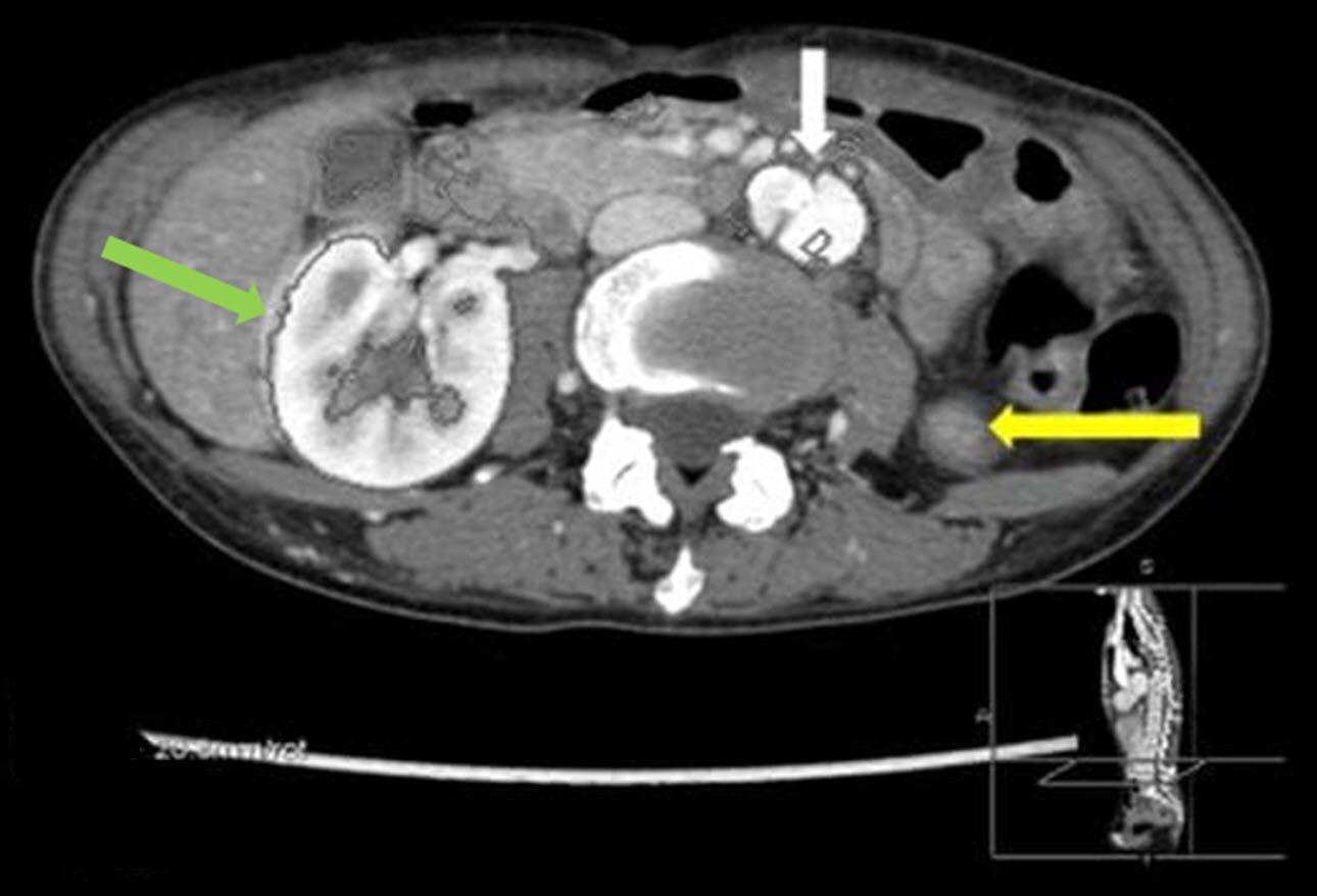 Aortic Dissection: A Double-Barreled Threat