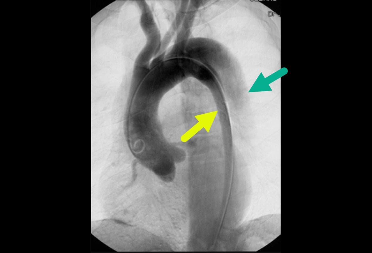 Aortic Dissection: A Double-Barreled Threat