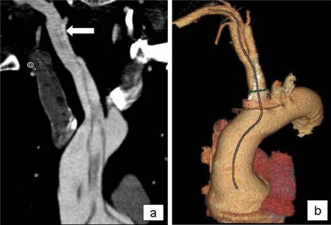 Aortic Dissection: A Double-Barreled Threat