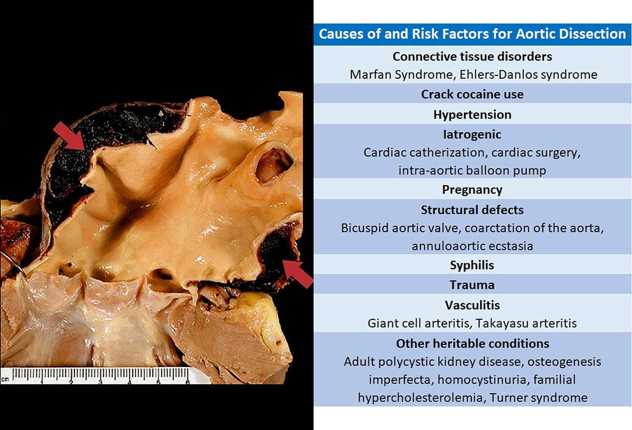 Aortic Dissection: A Double-Barreled Threat