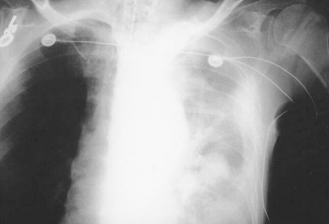 Aortic Dissection: A Double-Barreled Threat