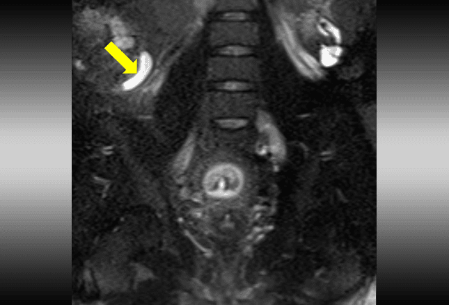 Appendicitis: Avoiding Pitfalls in Diagnosis