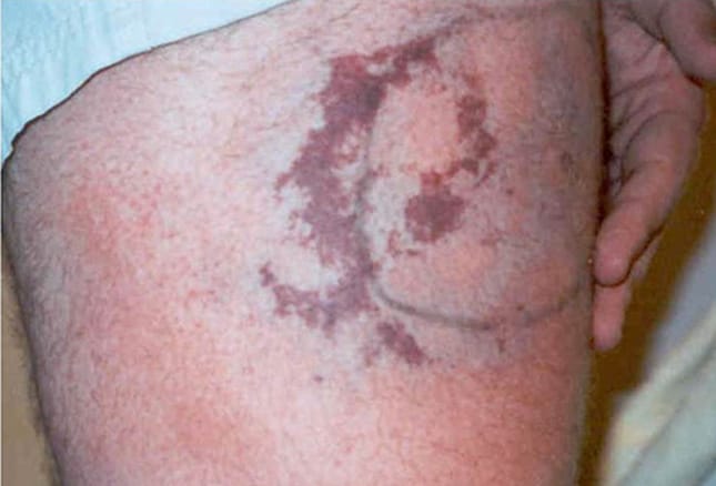 5 Arthropod Envenomations: From Benign Bites to Serious Stings