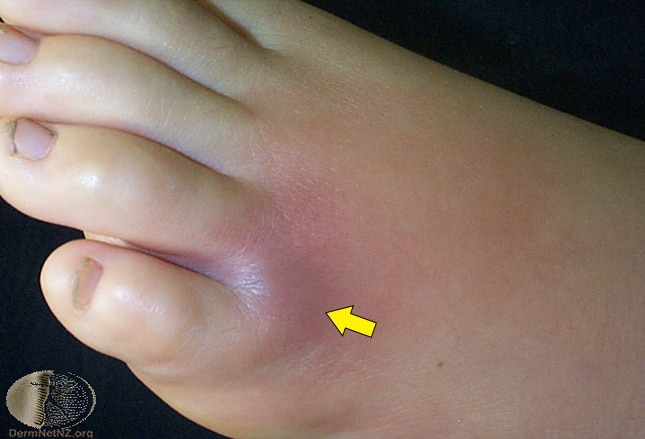 5 Arthropod Envenomations: From Benign Bites to Serious Stings