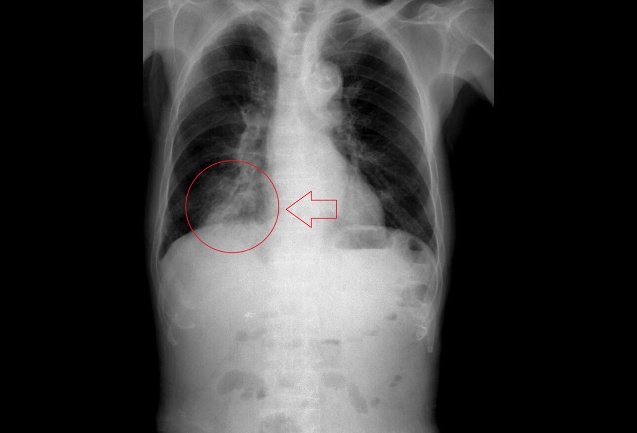 Awake Fiberoptic Intubation: Accessing the Airway