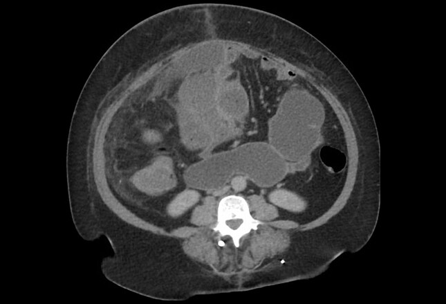 Complications After Bariatric Surgery: A Weighty Concern