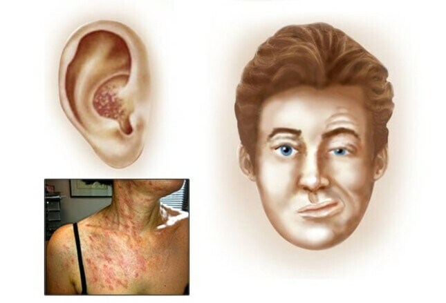 Bell Palsy: Diagnosis and Management