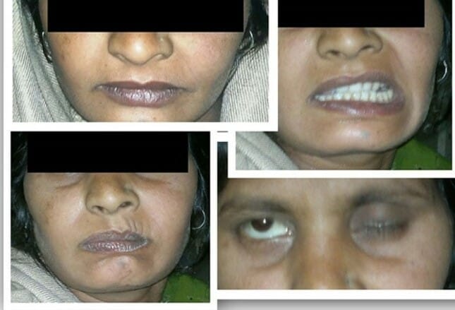 Bell Palsy: Diagnosis and Management