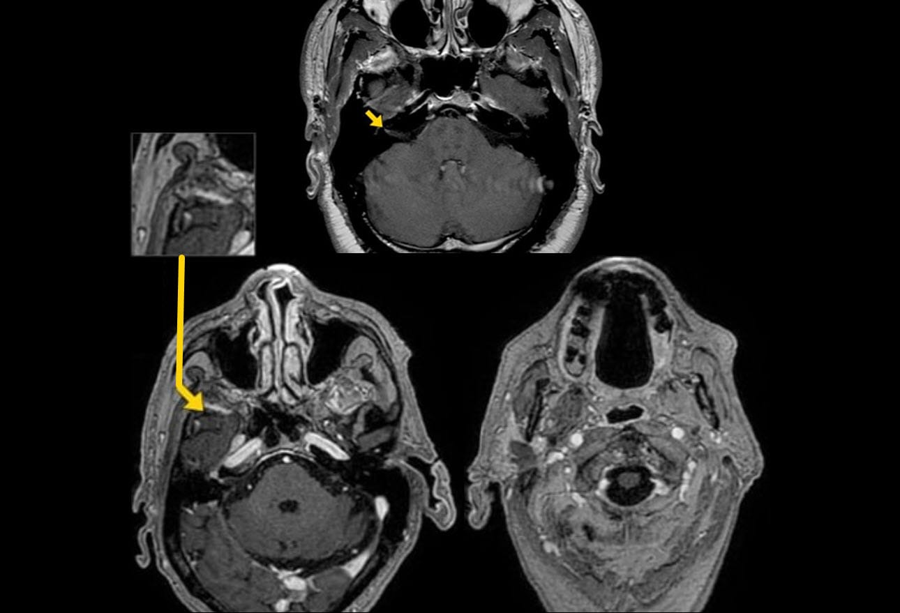 Bell Palsy: Diagnosis and Management