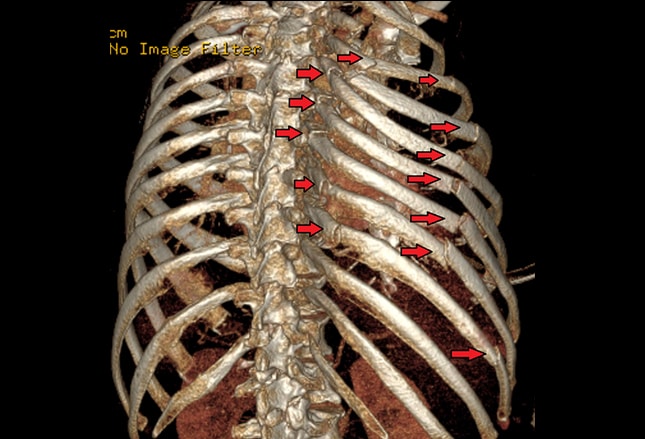 Hard Hits: Blunt Force Trauma
