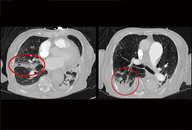Hard Hits: Blunt Force Trauma