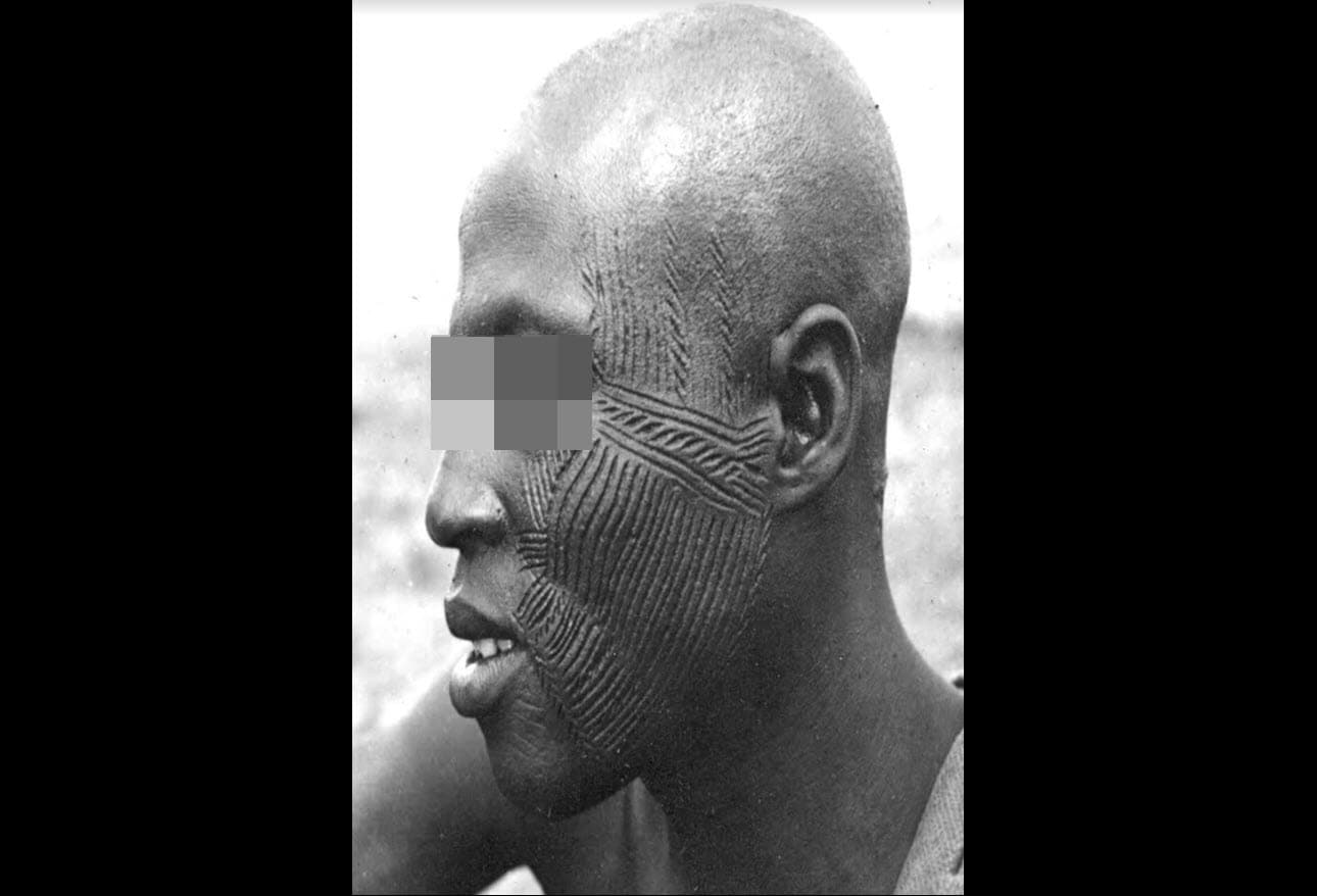 Body Modifications: Dermatologic Reactions and Risks