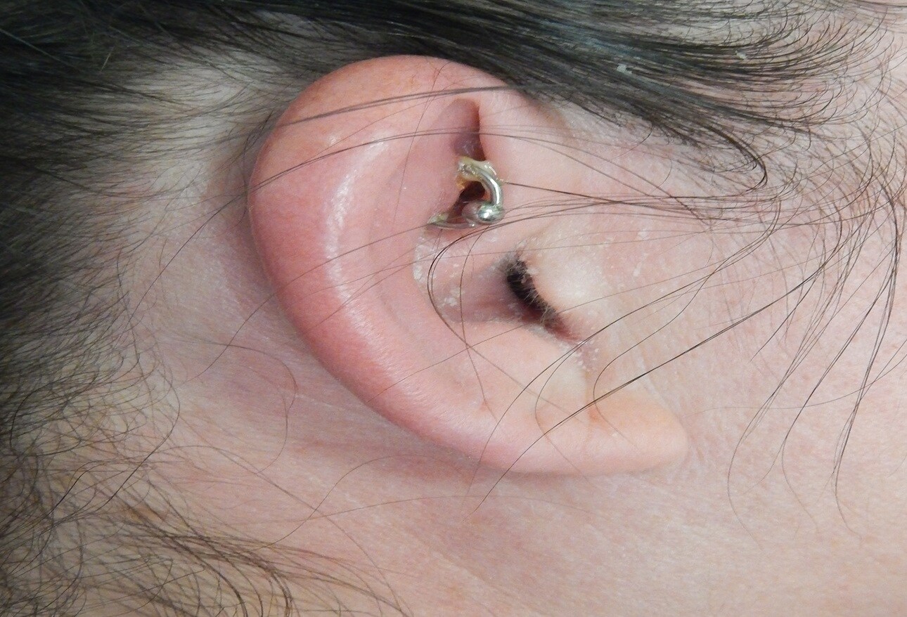 Body Modifications: Dermatologic Reactions and Risks