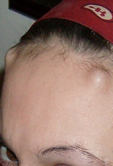 Body Modifications: Dermatologic Reactions and Risks