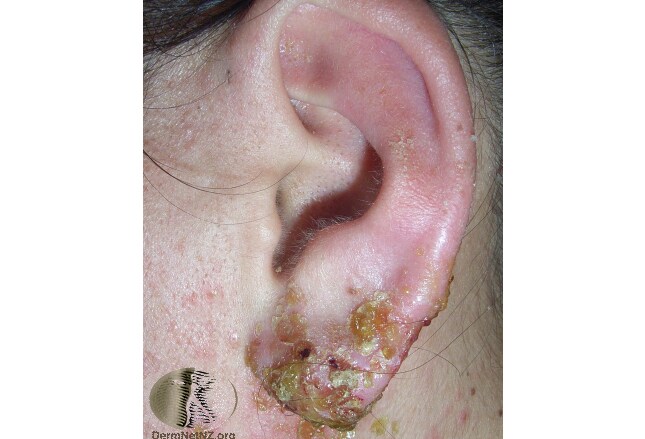 6 Body Modifications: Dermatologic Risks and Adverse Reactions