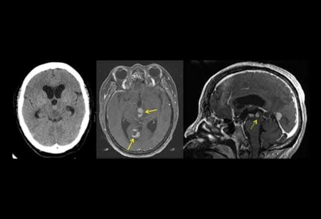 Brain Lesions: Summaries of 12 Cases