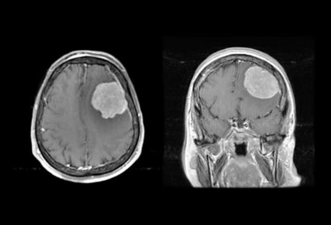 Brain Lesions: Summaries of 12 Cases