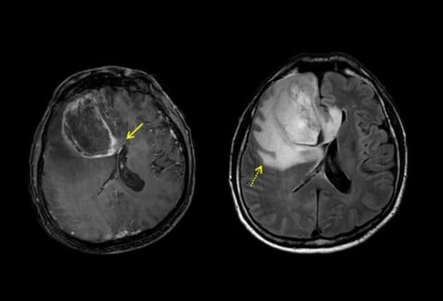 Brain Lesions: Summaries of 10 Cases