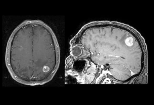 Brain Lesions: Summaries of 12 Cases