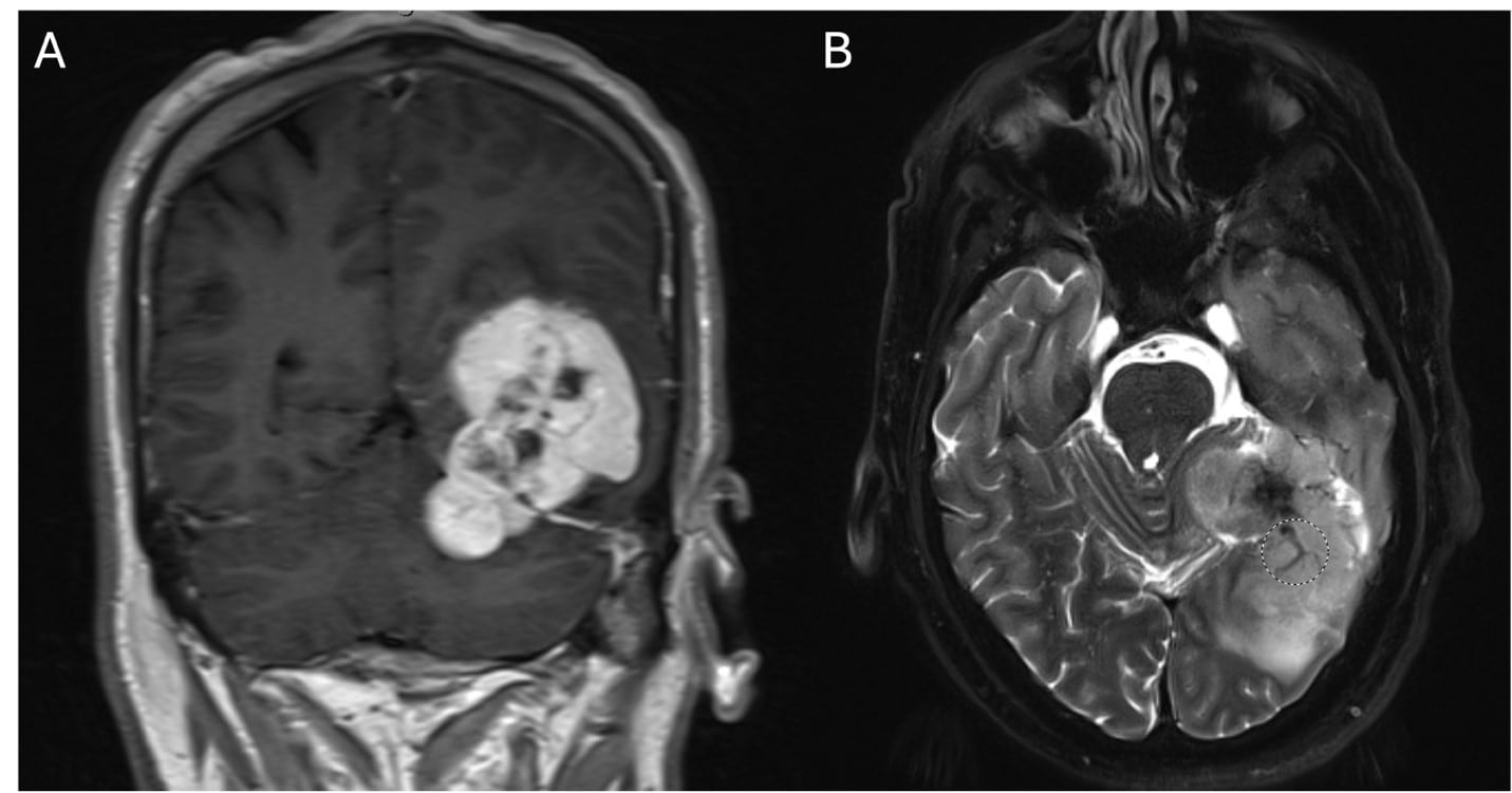 Brain Lesions: Summaries of 12 Cases