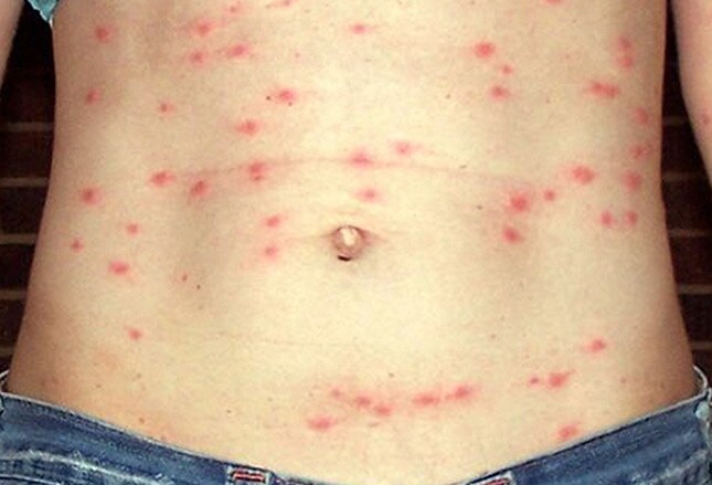 7 Bug Bites You Need to Know