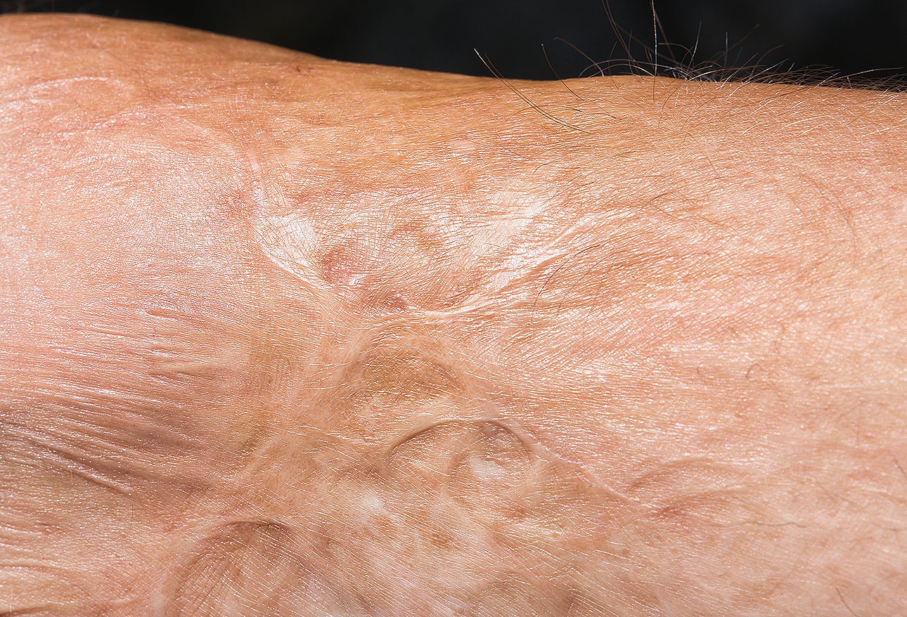 Burn Injuries: Complications and Care Options