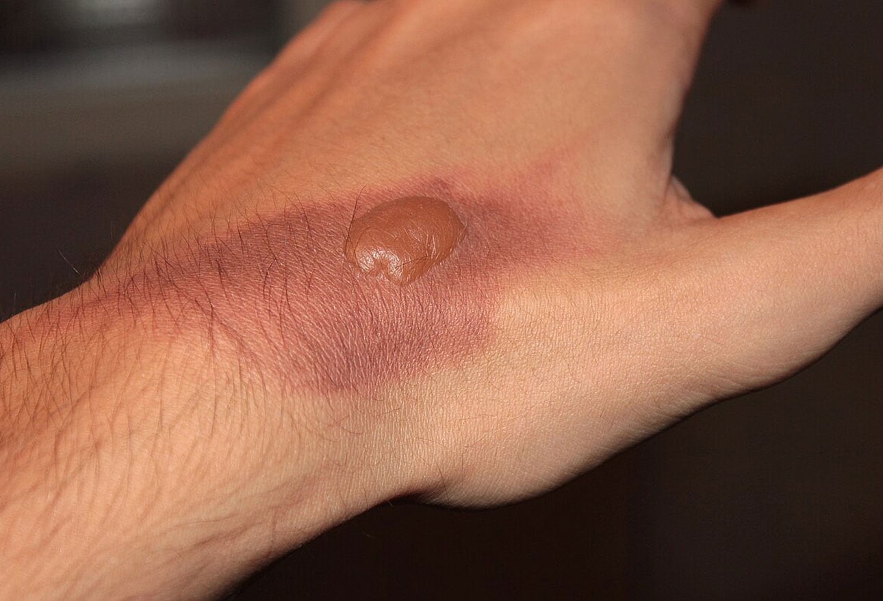 Burn Injuries: Complications and Care Options