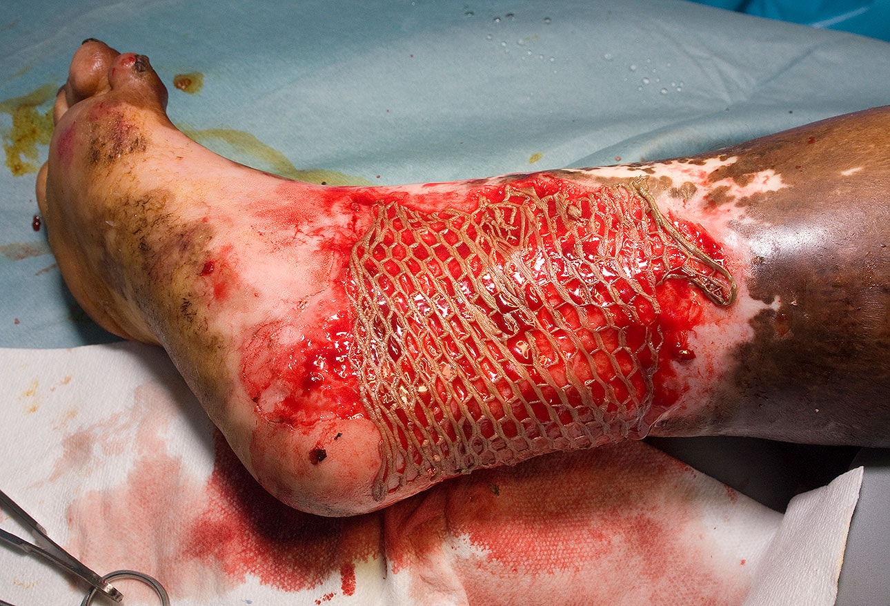 Burn Injuries: Complications and Care Options