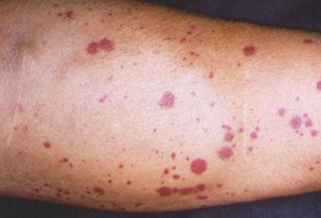 An Active-Duty Soldier With a Strange Rash: Case Presentation
