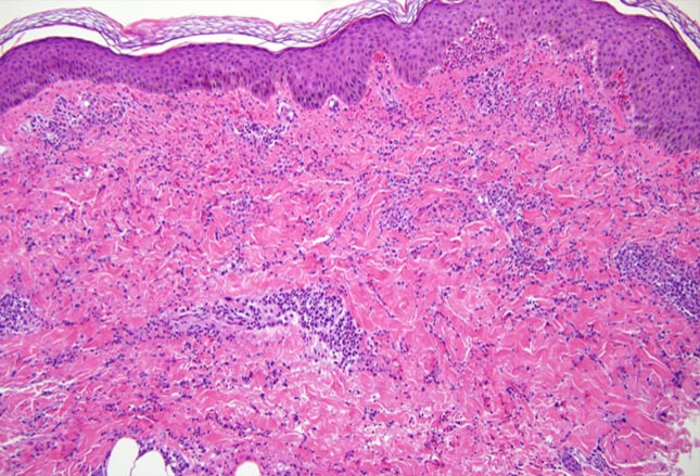 An Active-Duty Soldier With a Strange Rash: Case Presentation