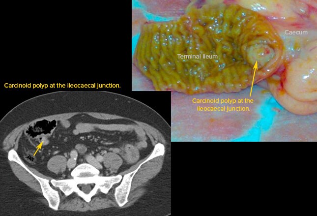 Carcinoid Tumors: Cancers in Slow Motion