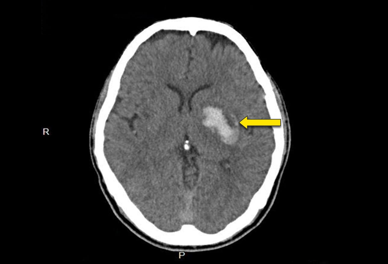 Cerebrovascular Accident: A Stroke of Misfortune