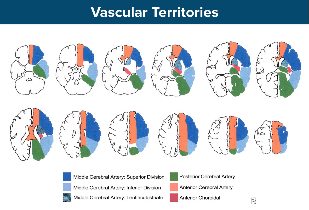 Cerebrovascular Accident: A Stroke of Misfortune