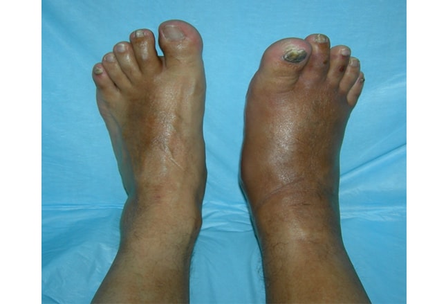 Red, Hot, and Swollen Foot in Diabetes: Charcot or No?