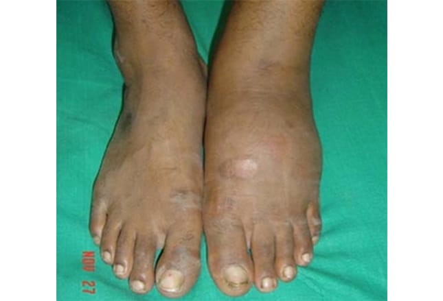 Red, Hot, and Swollen Foot in Diabetes: Charcot or No?