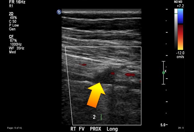 Red, Hot, and Swollen Foot in Diabetes: Charcot or No?
