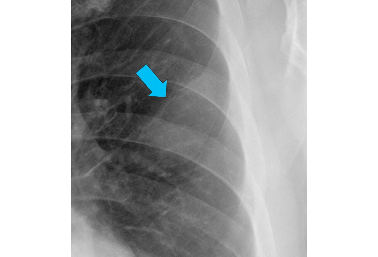 Chest X-Rays: 16 Subtle But Key Findings You Need to Know