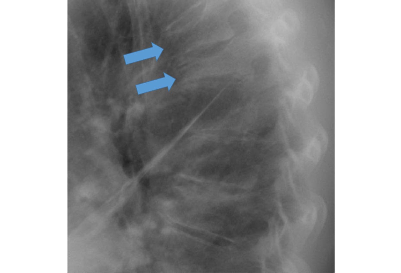 Chest X-Rays: 16 Subtle But Key Findings You Need to Know