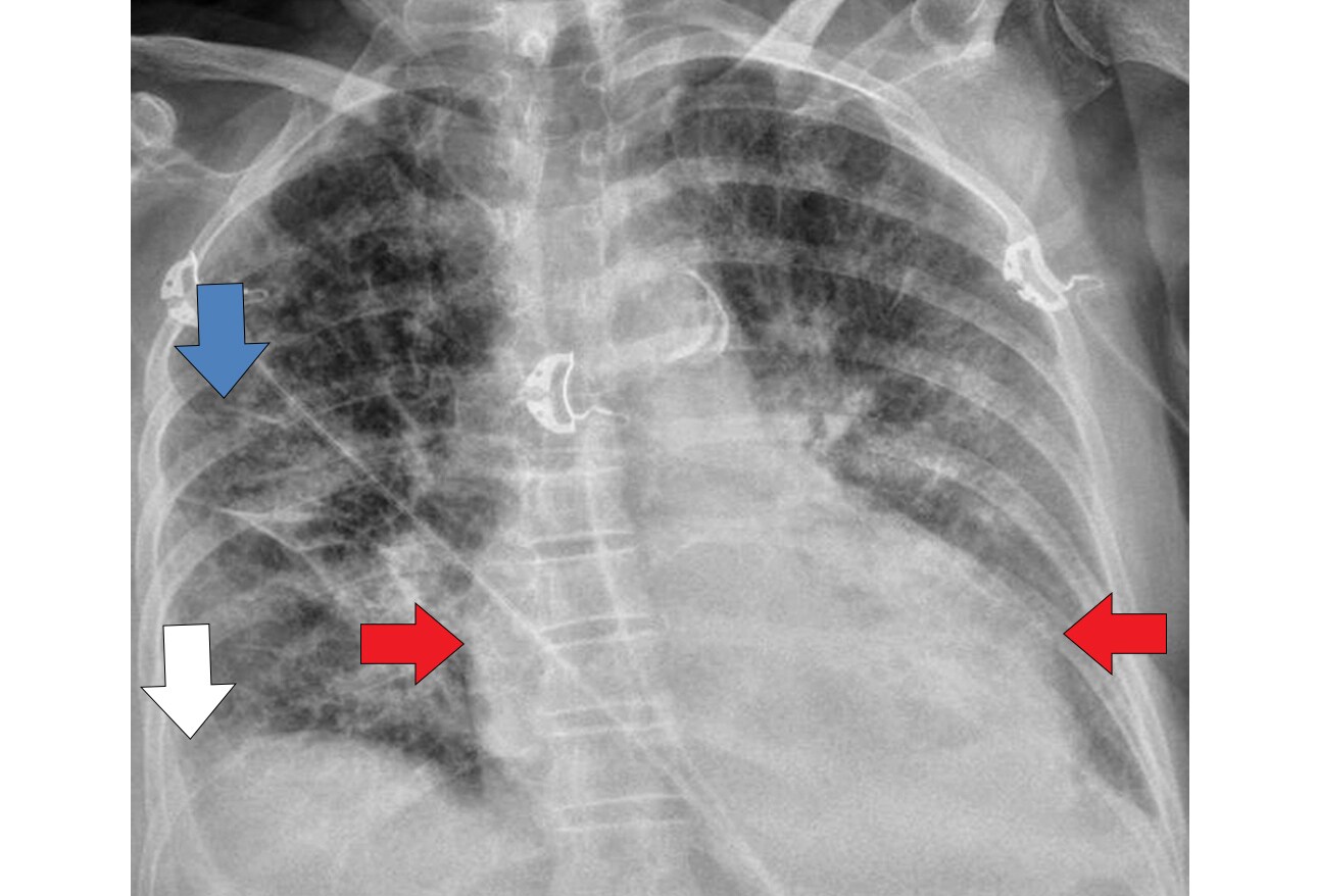 Critical Chest Radiographs: Can't-Miss Diagnoses