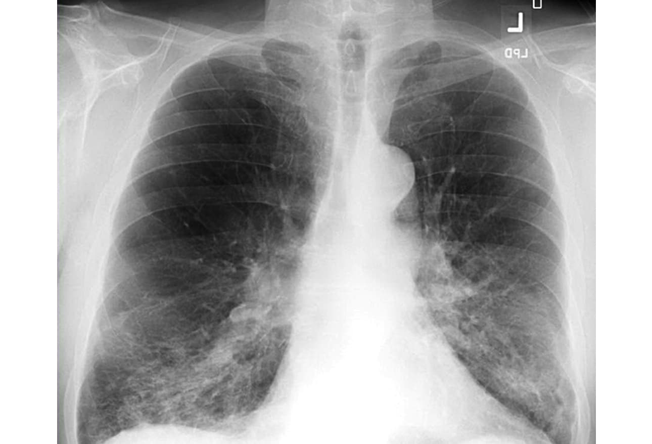 Critical Chest Radiographs: Can't-Miss Diagnoses