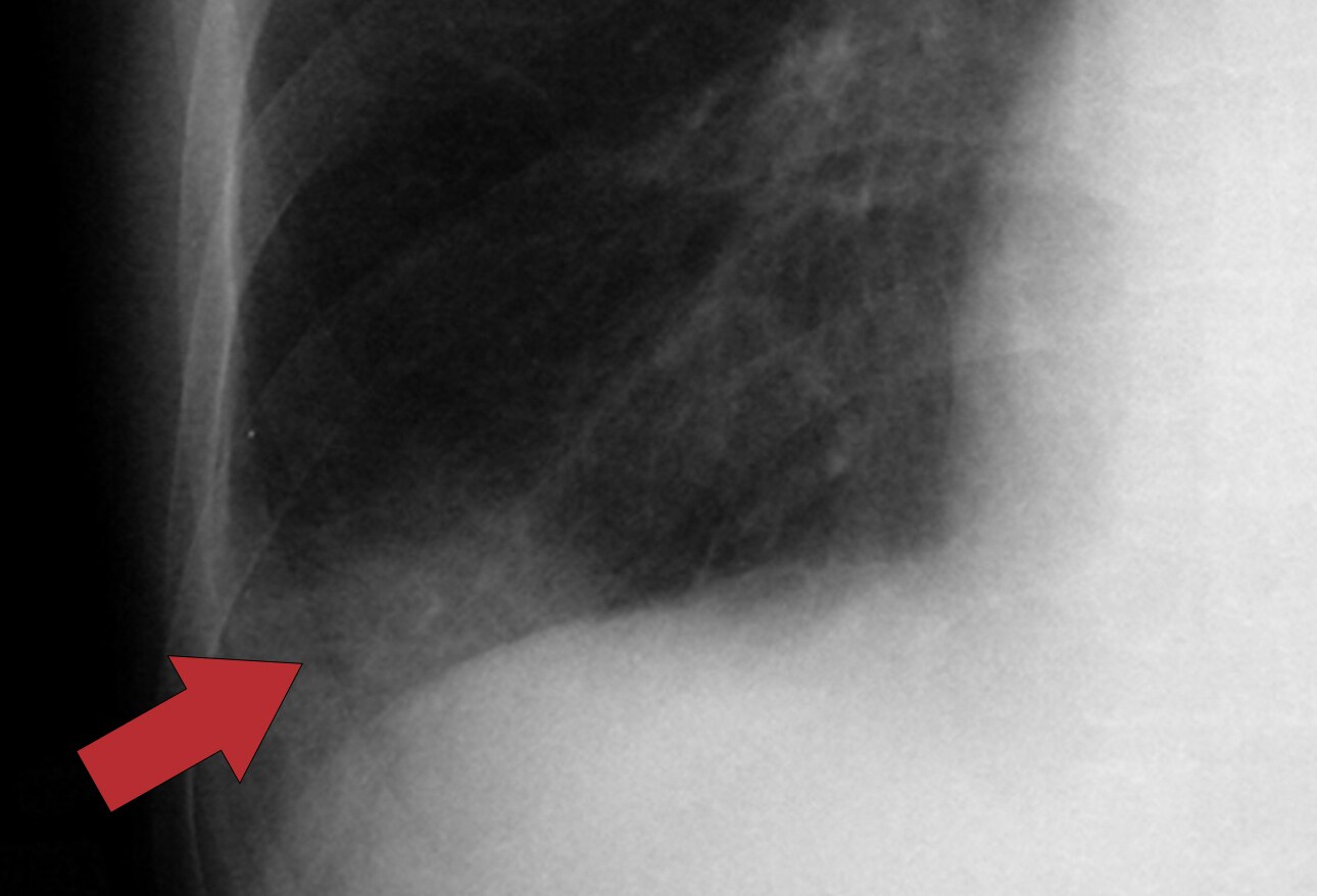 Critical Chest Radiographs: Can't-Miss Diagnoses