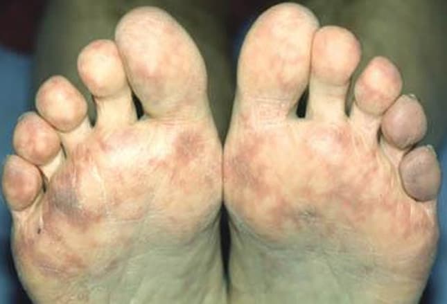 Hidden Heart Disease: 17 Dermatologic Clues You Should Know