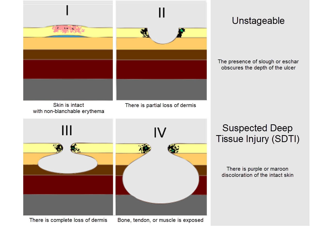 Breaking Down Bedsores and Understanding Ulcers: Pressure Injuries